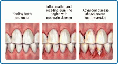Healthy Vs Unhealthy Gums