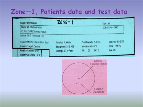 Visual Field Analysis Interpretation Pptx Eye And Vision Visual Field Analysis Interpretation Pptx Eye And Vision