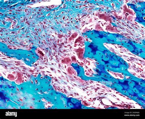 Light Microscopy Of Osteoclasts Around A Dozen Osteoclasts Are Seen As