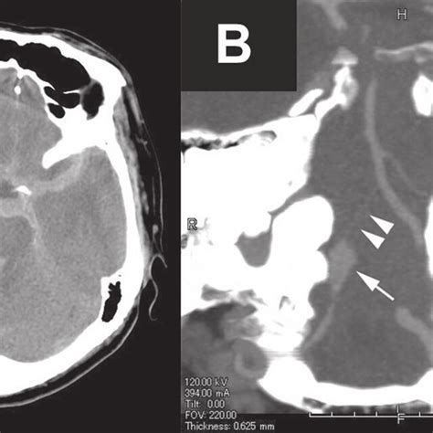 A Computed Tomography Of The Brain Demonstrating Diffuse Hemorrhage Download Scientific