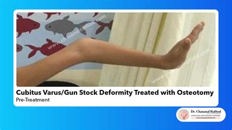 Gun Stock Deformity What Is It At Hudson Facy Blog