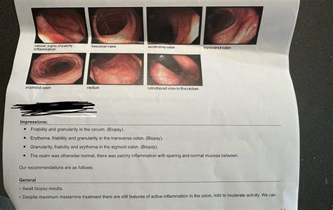 Distal Colitis To Patchy Inflammation Rulcerativecolitis