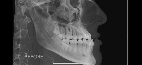 Why Did My Surgeon Give Me A Genioplasty With Underbite Surgery I Dont Like It R Jawsurgery