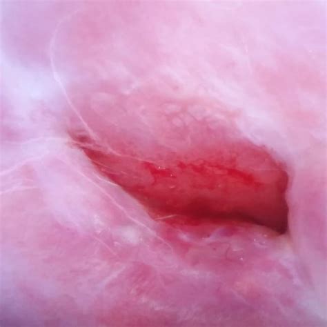 Lesion In Cervix Instance Segmentation Dataset By Cervical Cancer Project