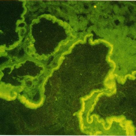 Antibodies To Corneal Epithelium In Fuchs Heterochromic Cyclitis As