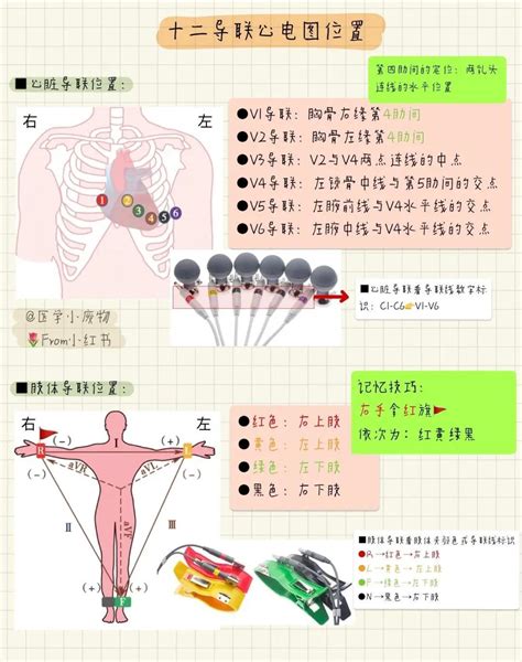 心电图导联位置记忆法