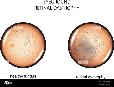 Vector Illustration Of The Fundus Retinal Dystrophy Stock Vector Image