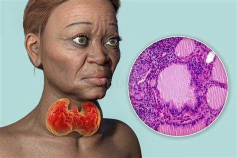 Disease Goiter Stock Illustrations 1053 Disease Goiter Stock
