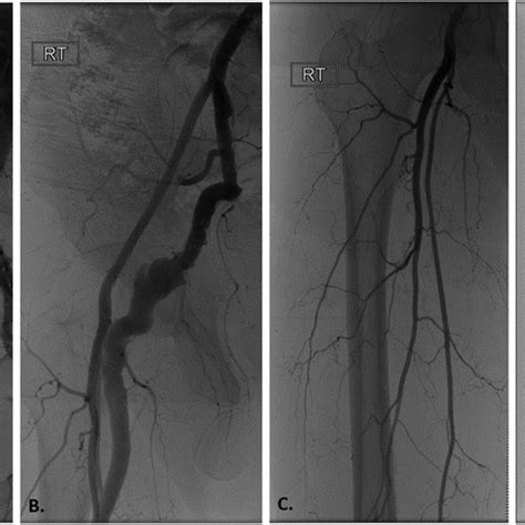 Intra Operative Angiography Scan Prior To Persistent Sciatic Artery