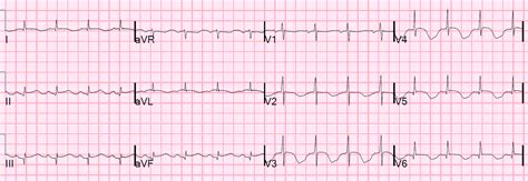 Bizarre T Wave Inversions With Negative U Waves And Very Long Qt And