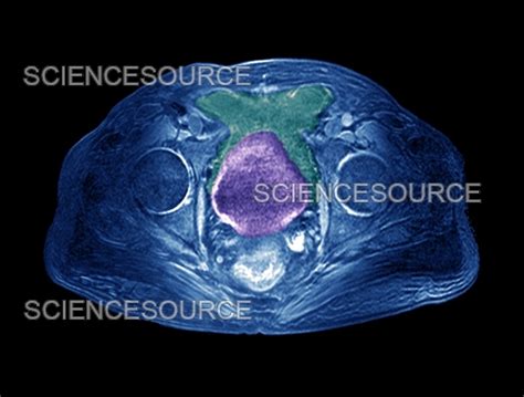 Prostate Cancer Mri Stock Image Science Source Images