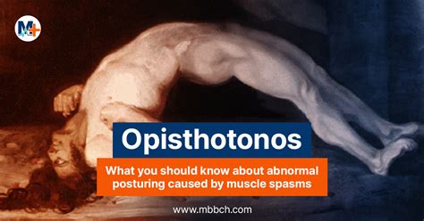 Opisthotonos Abnormal Posturing Mbbch Health Encyclopedia