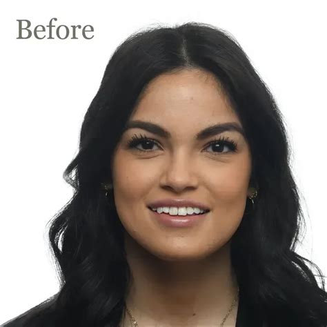 Teeth Alignment Hansen Orthodontics