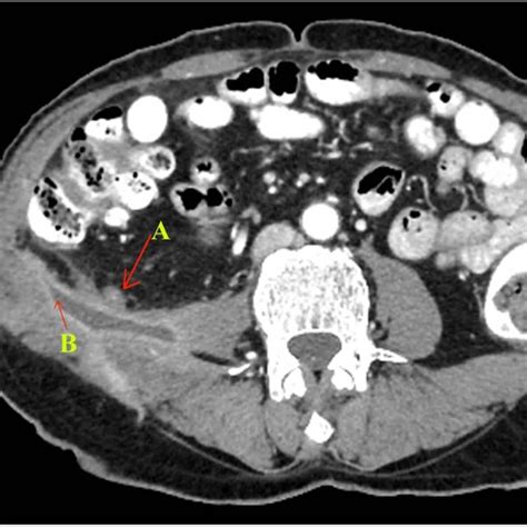 Intraoperative Image Showing Retrocaecal Appendix With Tip Adhered To