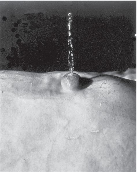 59 Ascites And Its Complications Abdominal Key