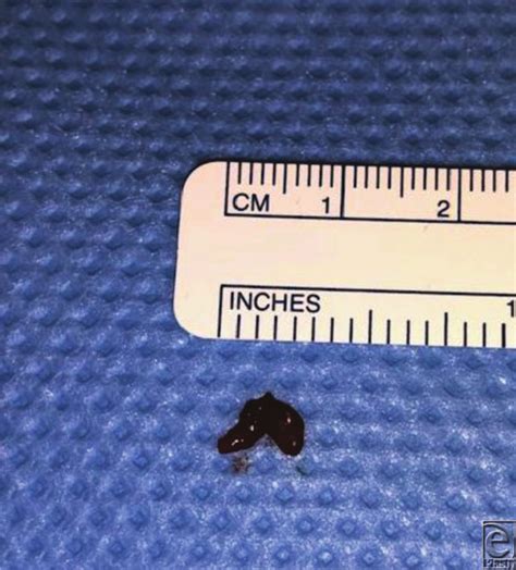 Transected Arterial Specimen Note That The Corkscrew Conformation