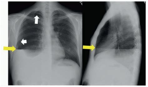Hydropneumothorax Radiology Key
