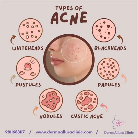 Types Of Acne Acne In Different Areas Types Of Pimples Acne Chart