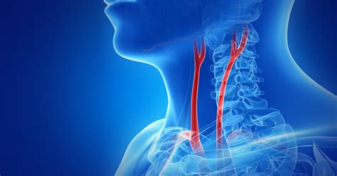 Carotid Artery Aneurysm Extracranial Medstar Health