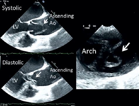 Figure 2 From Intimointimal Intussusception In Both The Proximal And Distal Ascending Aorta A
