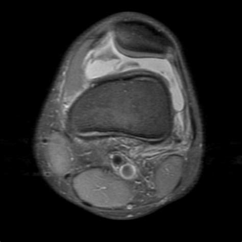Radiopaedia Case Lateral Patellar Dislocation Id 15234 Study 15077