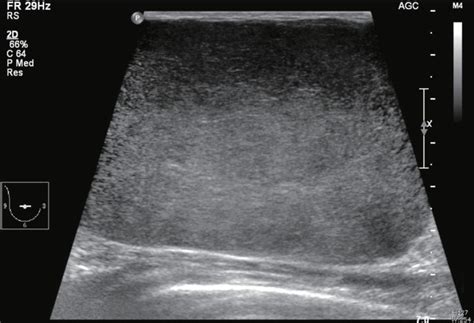 An Ultrasonogram Showing A Well Capsulated Giant Homogeneous Isoechoic Download Scientific