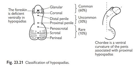 Paediatrics Hypospadias