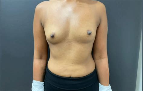 Breast Augmentation Form Face Body Form Face Body
