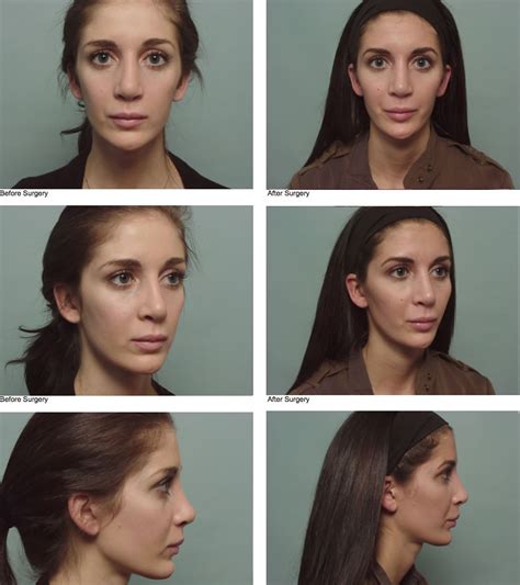 Do Cheek Implants Move At Christian Brown Blog