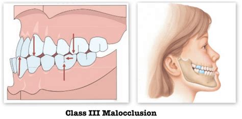 Class 3 Malocclusion Causes Signs And Treatment Atlas Dental
