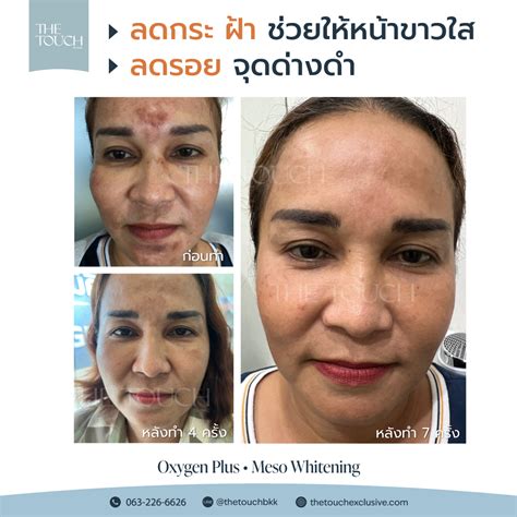 Review Meso Whitening