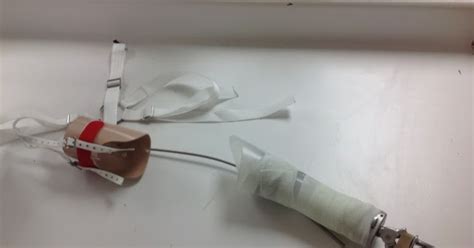 The Orthoprosthetists Progress Transradial Prosthesis