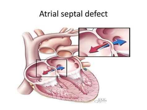 Atrial Septal Defect Pdf