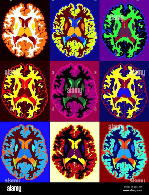 These Are Axial Mri Scans Of A Person With Multiple Sclerosis That Have
