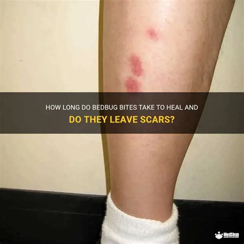 How Long Do Bedbug Bites Take To Heal And Do They Leave Scars Medshun
