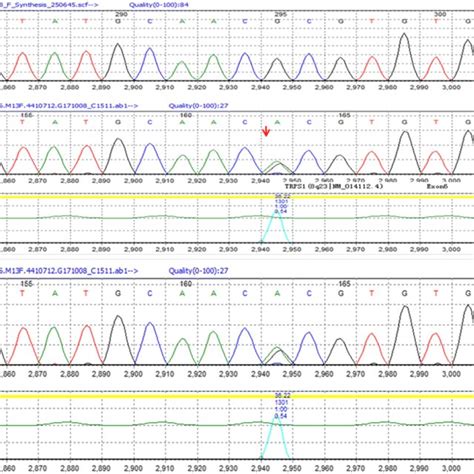 Typical Dysmorphological Features Of The Girls Father Including Short