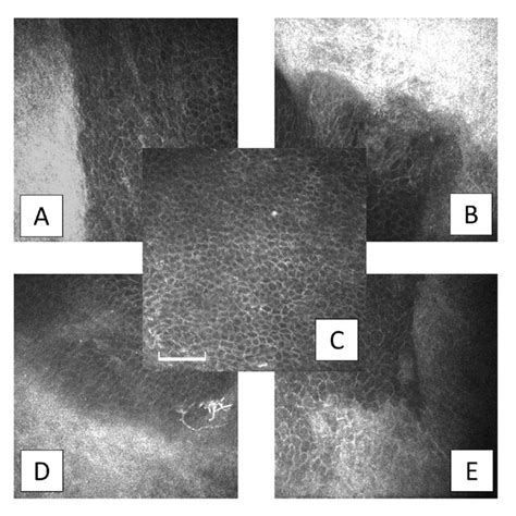 Central Epithelium And Transition Zone At 6 Month Evaluation After