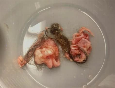 Womans Ultrasound Shows Cyst Growing Hair And Teeth Weird News