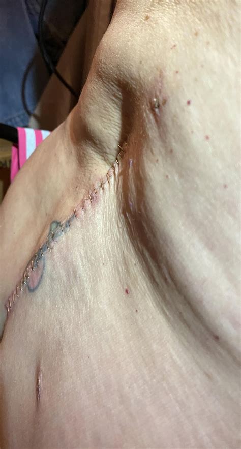 10days Post Op Seroma R Spinalfusion
