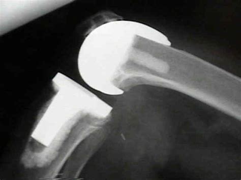 Tibial Extramedullary Guides Wheeless Textbook Of Orthopaedics