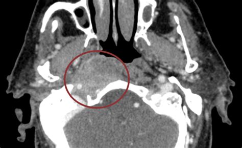 Osteomyelitis Of Skull Radiology At Phillip Hayes Blog