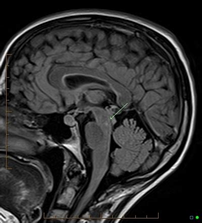 Medial Longitudinal Fasciculus Mri