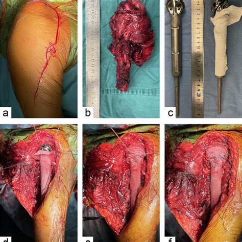 Operative Details Of Tumor Type Hemi Shoulder Replacement In Proximal Download Scientific