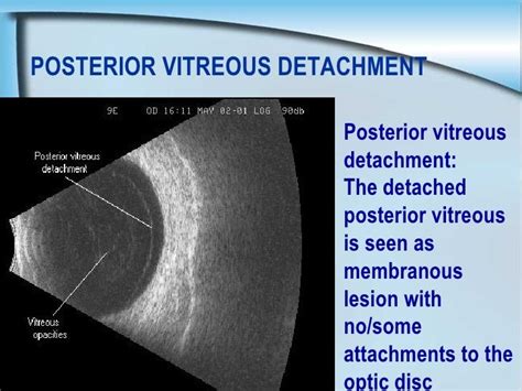 Posterior Vitreous Detachment Ultrasound