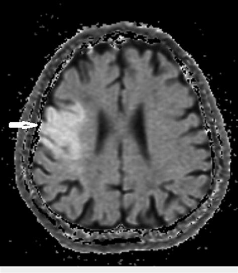 Figure 1 From Treatment Of Post Stroke Dysphagia With Interferential