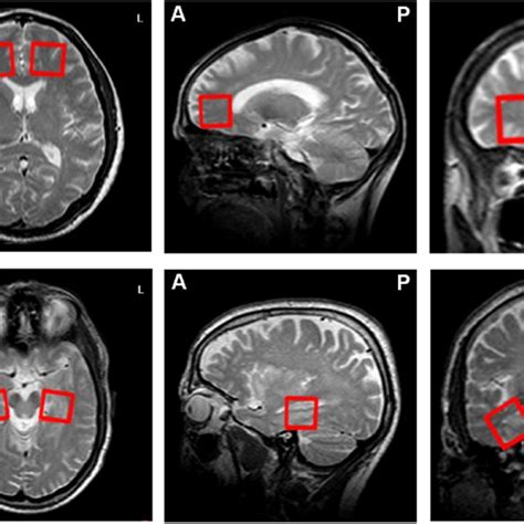 Representative Magnetic Resonance Imaging Images Illustrating The Voxel Download Scientific