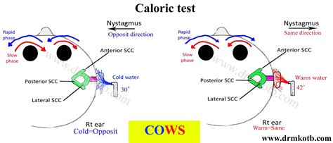 Caloric Test
