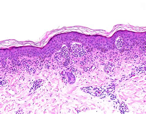 Dermatitis Herpetiformis Histology