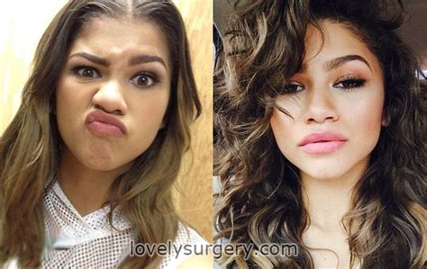 Zendaya Before Surgery