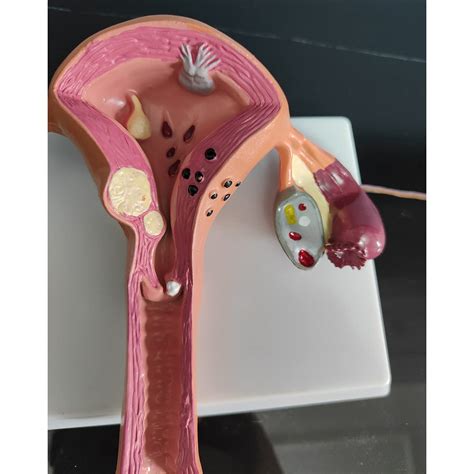 Siulas Pathological Uterus Model Life Size Human Uterus India Ubuy